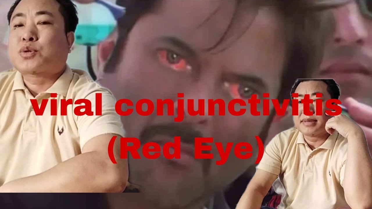 l Viral Conjunctivitis l Symptoms and Precautions l jonathan obit tali ...