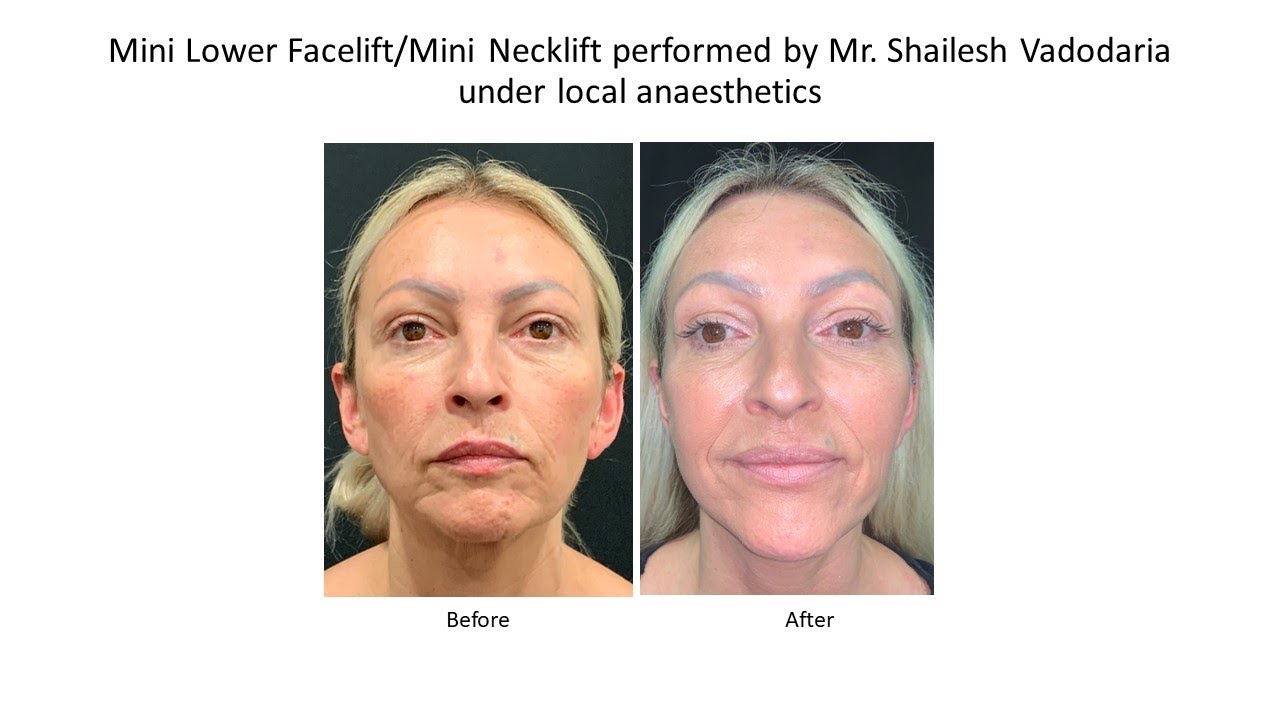 Mini Lower Facelift/Mini Necklift under local anaesthetics/sedation - 5 ...