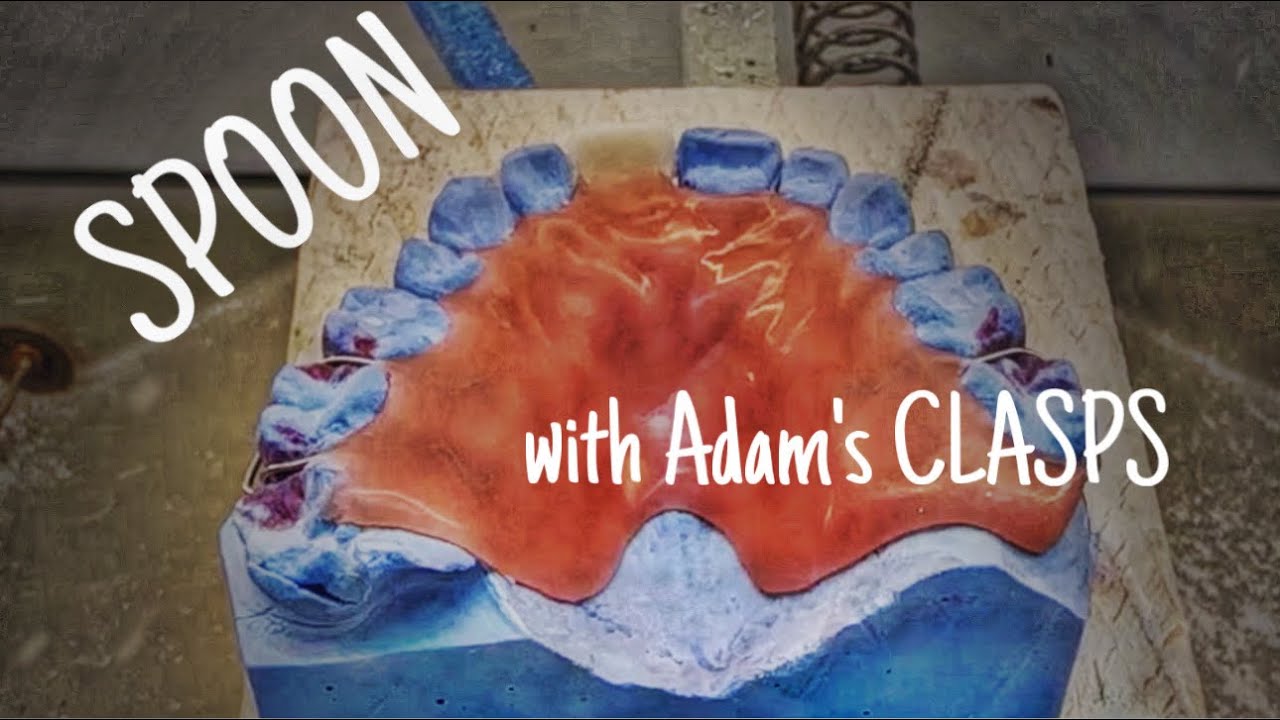 Acrylic SPOON with Adam’s Clasps & Composite Tooh #denture #teeth # ...