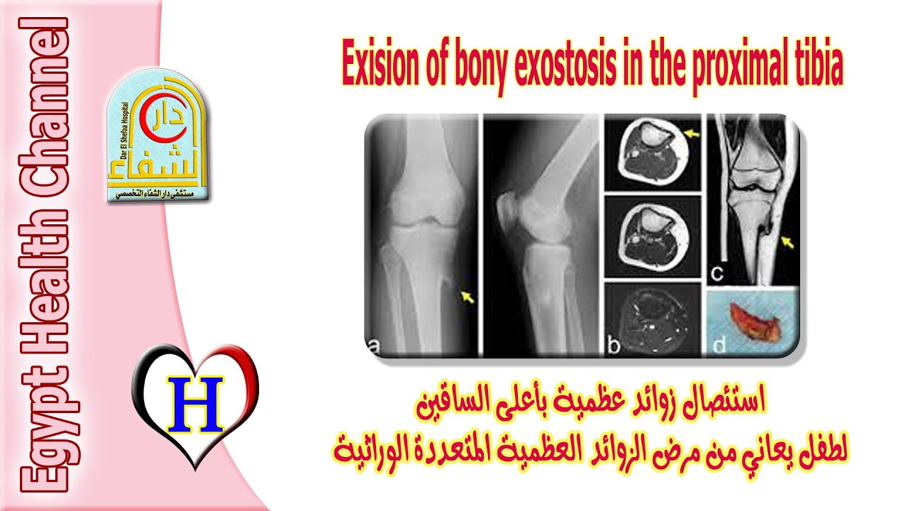Exision of bony exostosis in the proximal tibia - استئصال زوائد عظمية ...