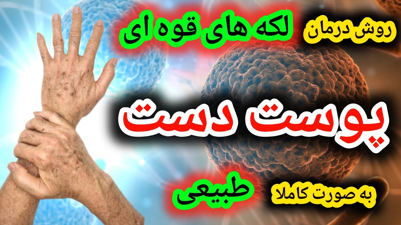 درمان لکه های قهوه ای پوست دست به صورت کاملا طبیعی Youtube