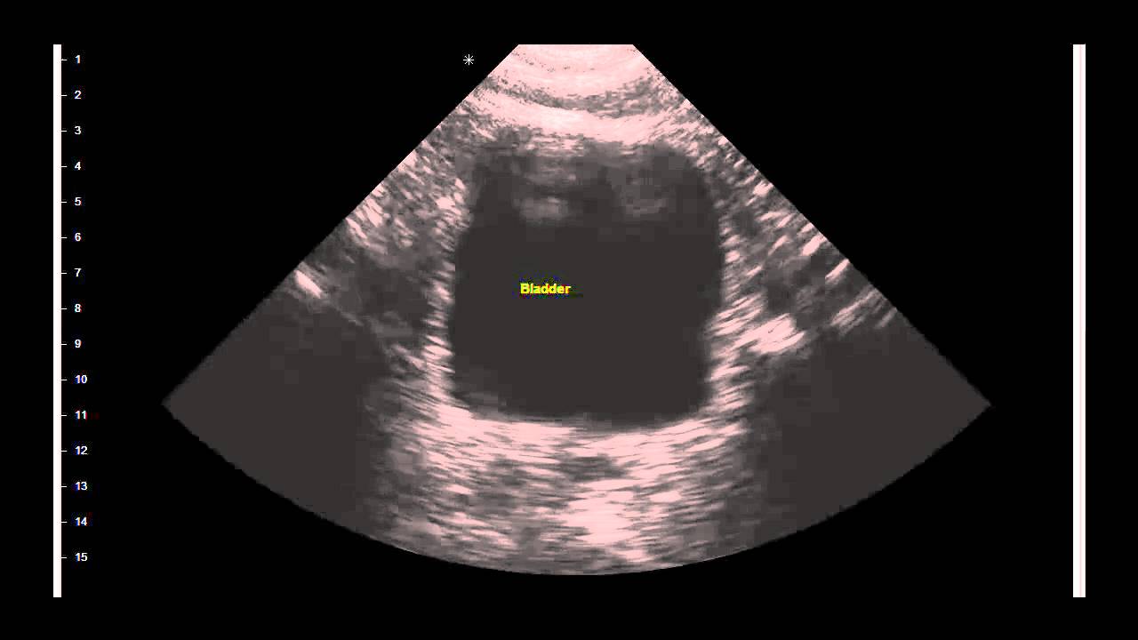 Bladder, Transverse View - YouTube