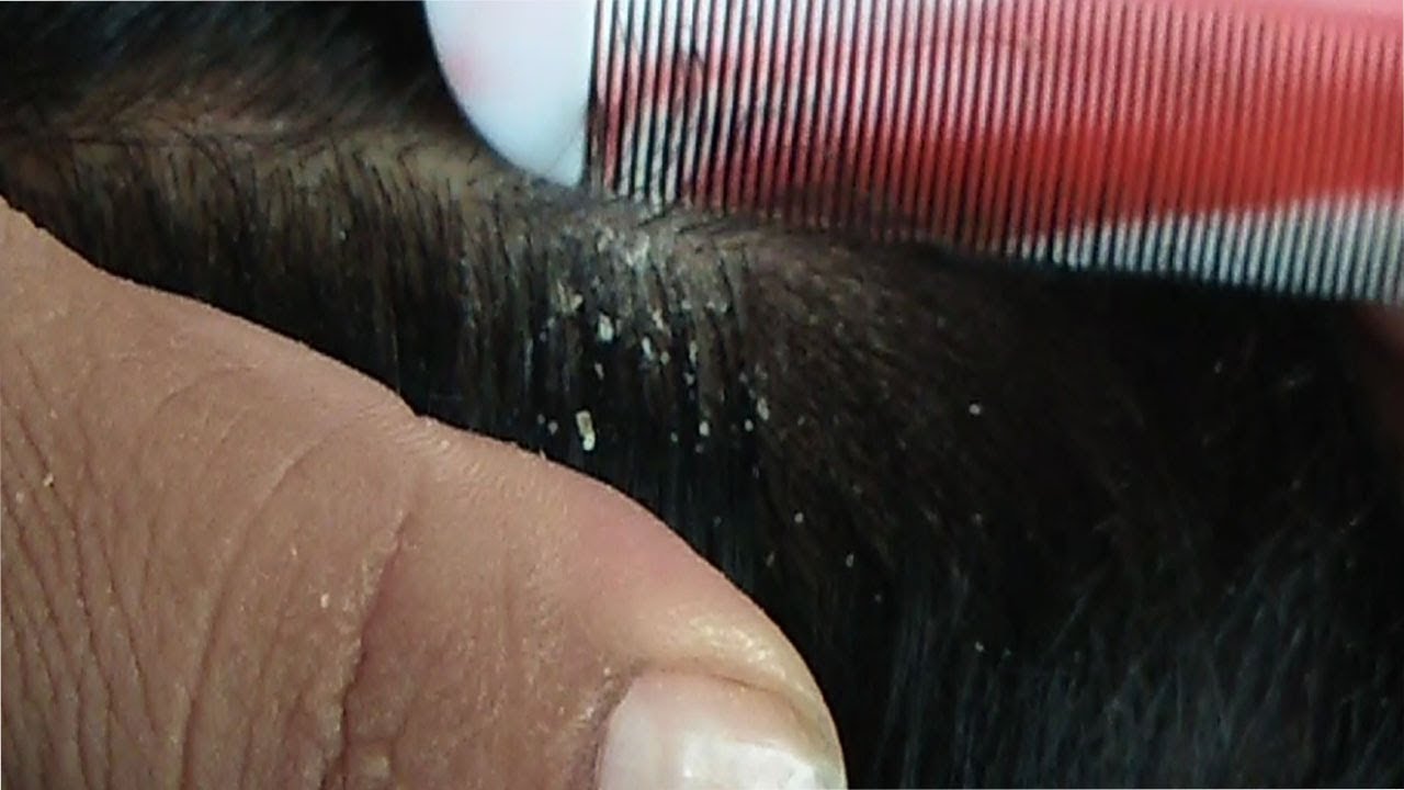 Dandruff/Extreme Dandruff Scratching / Extreme Flakes / Removing Big ...