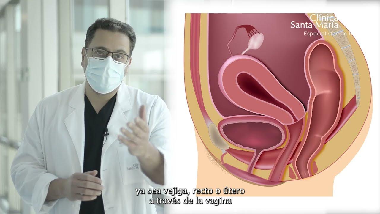 Prolapso uterino: Síntomas y tratamientos - YouTube
