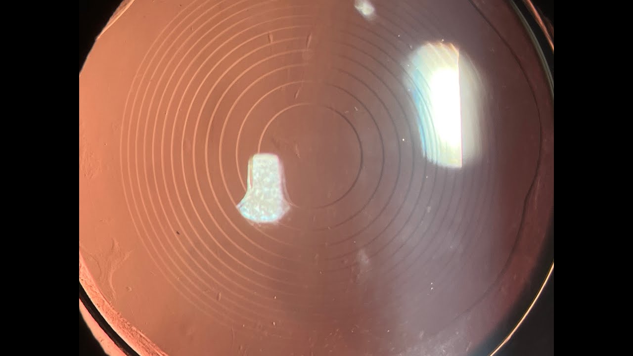 Apodization IOL - Apodización LIO. Artis PL M Add E + 3,00 D - YouTube