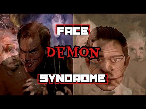 The Demon Face Syndrome aka Prosopometamorphopsia DemonFaceSyndrome ...
