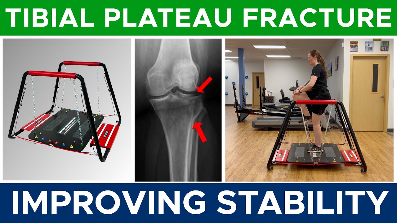 Tibial Plateau Fracture: Improving Dynamic Knee Stability ...