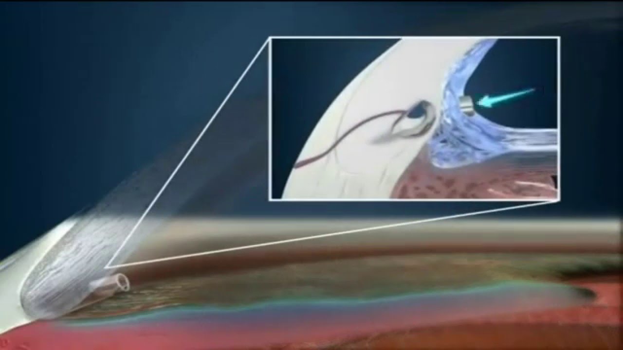 Istent -Glaucoma Patients have a Revolutionary NEW Treatment Option ...
