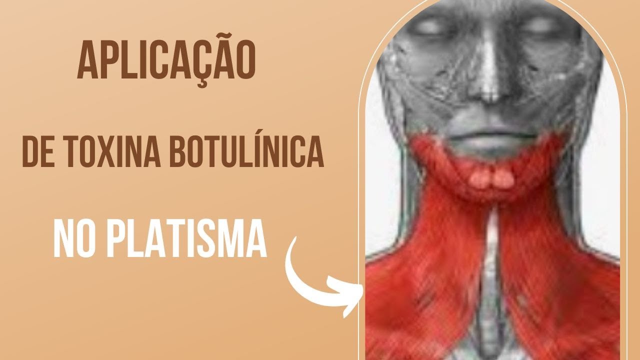 APLICAÇÃO de TOXINA BOTULÍNICA no PLATISMA - YouTube