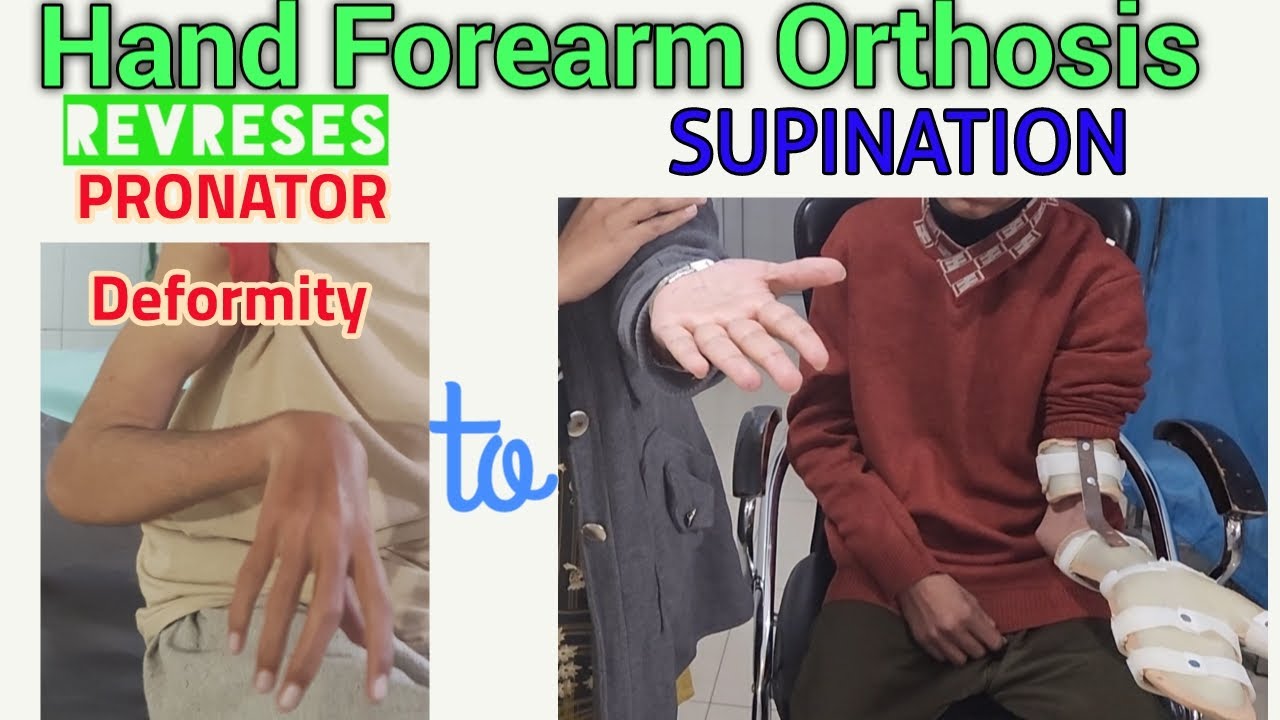 Hand Forearm Orthosis || Supinator Support Brace - for Correcting ...