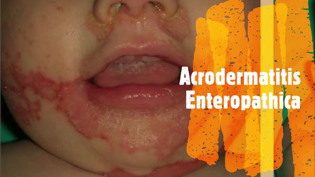 Acrodermatitis enteropathica - YouTube