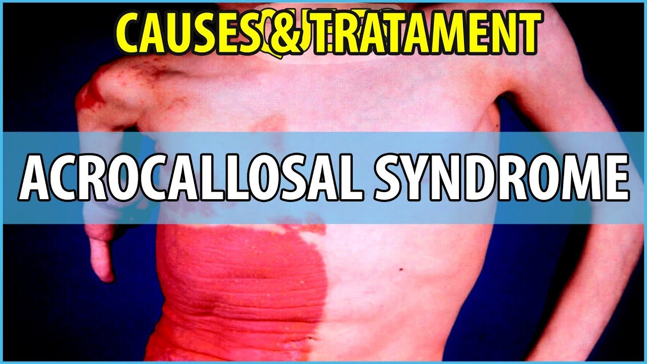 What is Acrocallosal Syndrome, Causes, Symptoms and Treatments - YouTube