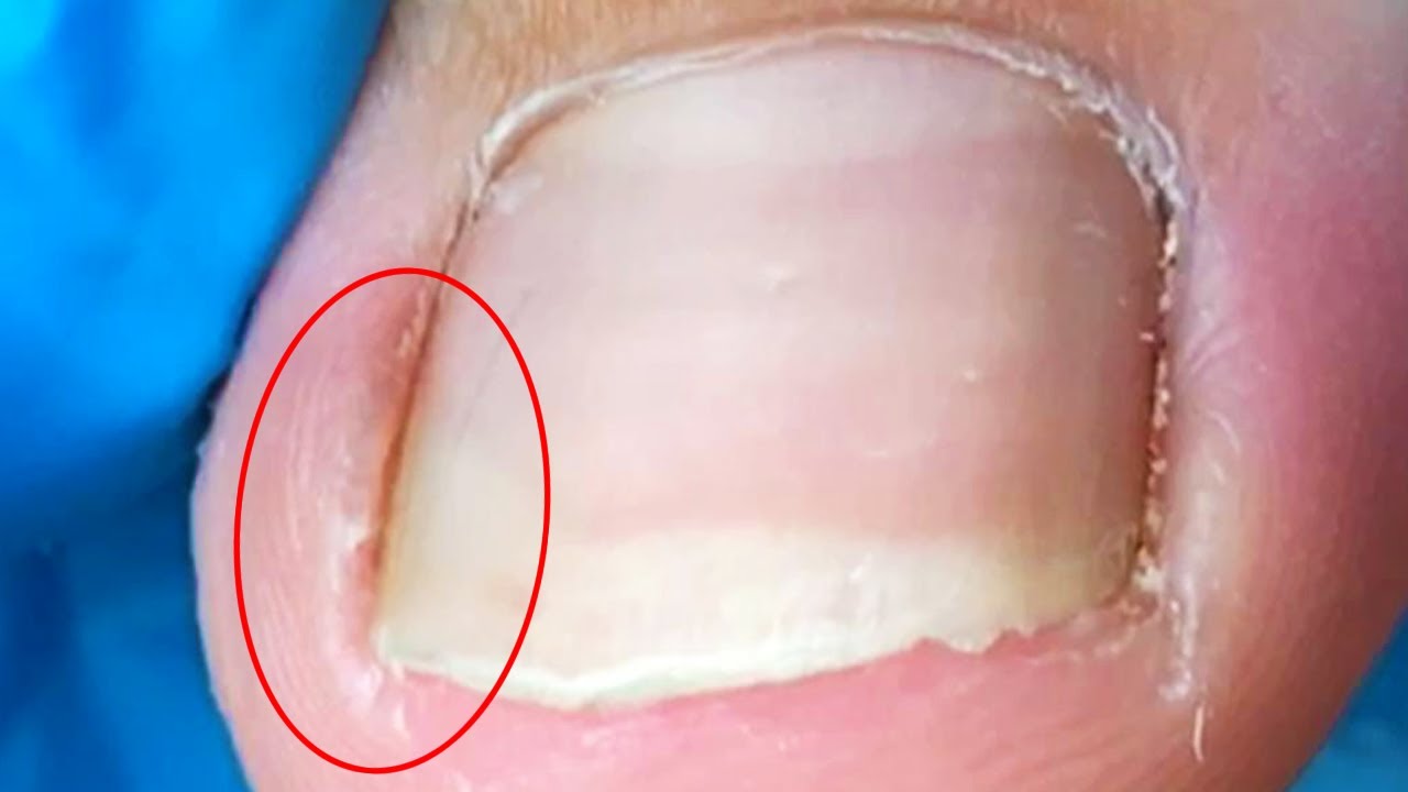 The toenails are very long, please trim them【Crazy pedicure room】 - YouTube