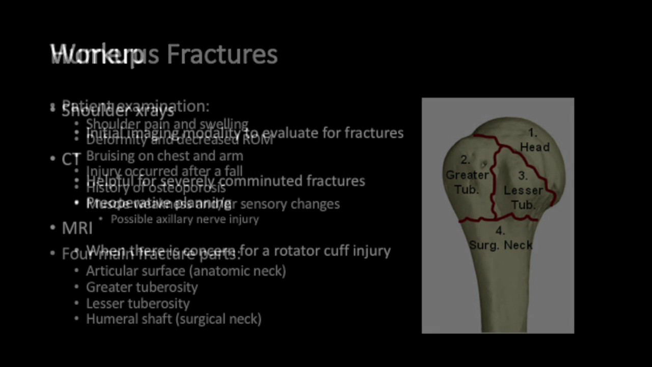 Proximal Humerus Fracture Repair - YouTube