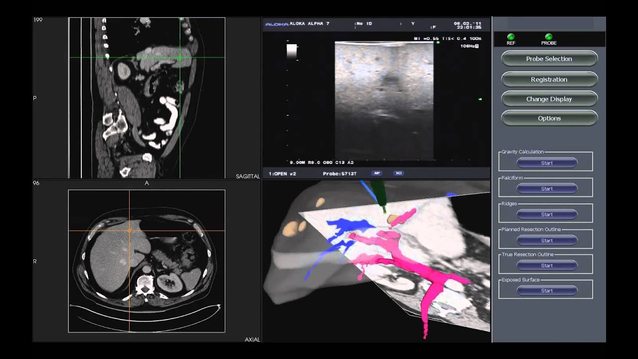 Image-Guided Liver Ablation with Navigated Ultrasound - YouTube