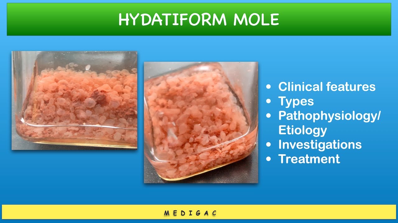 Hydatidiform Mole - Clinical features | Types | Pathophysiology ...