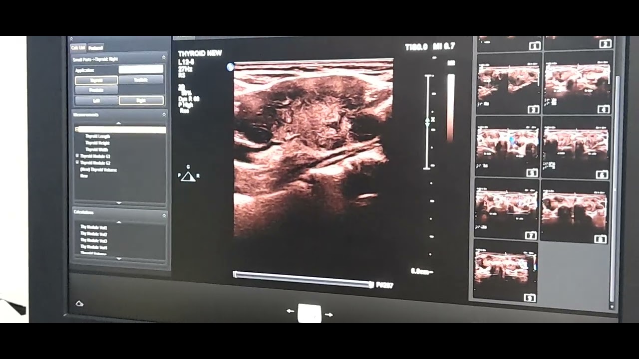 Diffusely enlarged multinodular goiter - YouTube