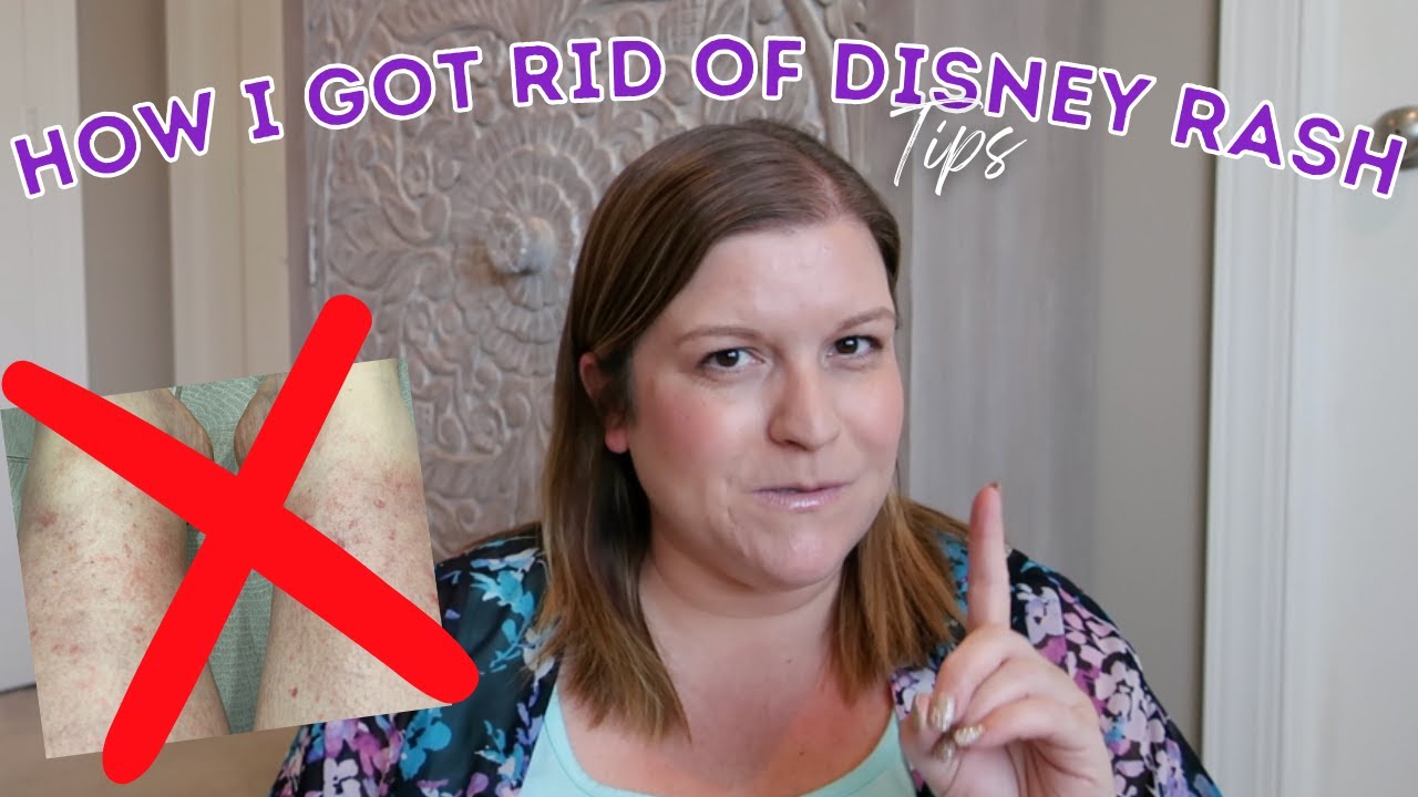 HOW I Got RID of DISNEY RASH While Still in the Heat | 3 Tips - YouTube
