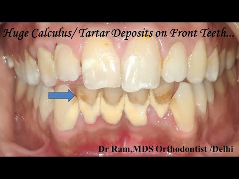 Huge Tartar/Monster Calculus on Front Teeth in Young Age. पायरिया ...