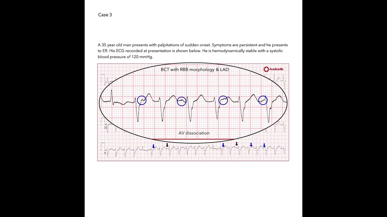 Case 3 Explanation - YouTube