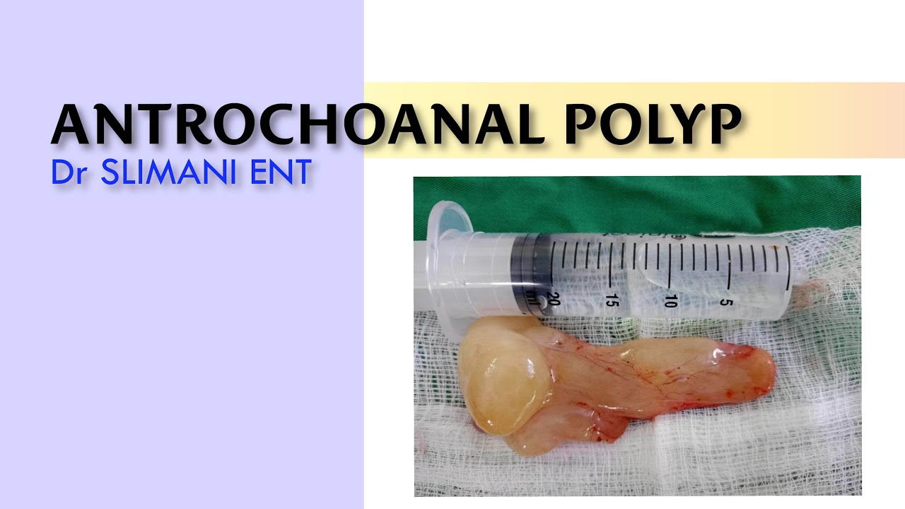 👃 Endoscopic Surgery for Antrochoanal Polyp | Watch the Transformation ...