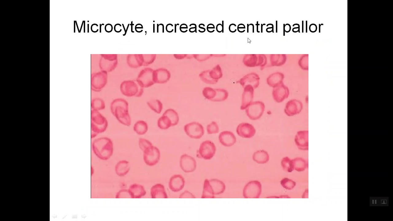 Red Cell Morphology Heamatology Youtube