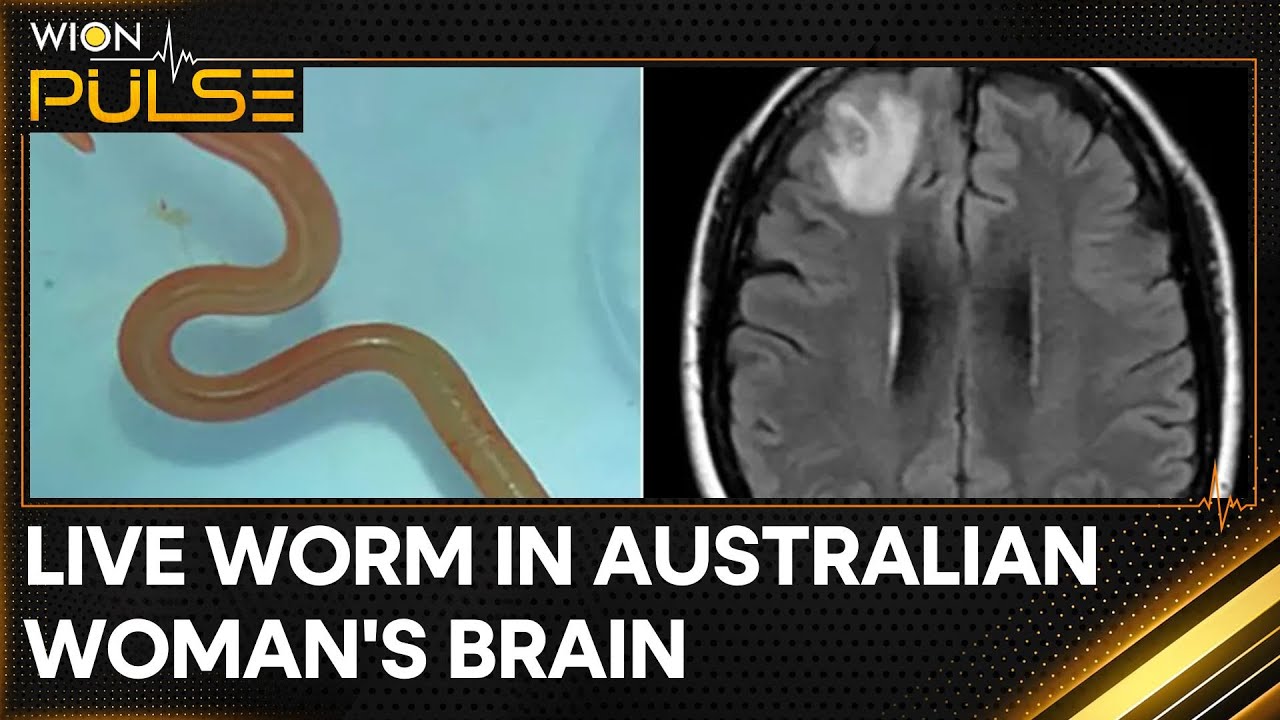 Australia doctors make shocking discovery, find living worm inside ...