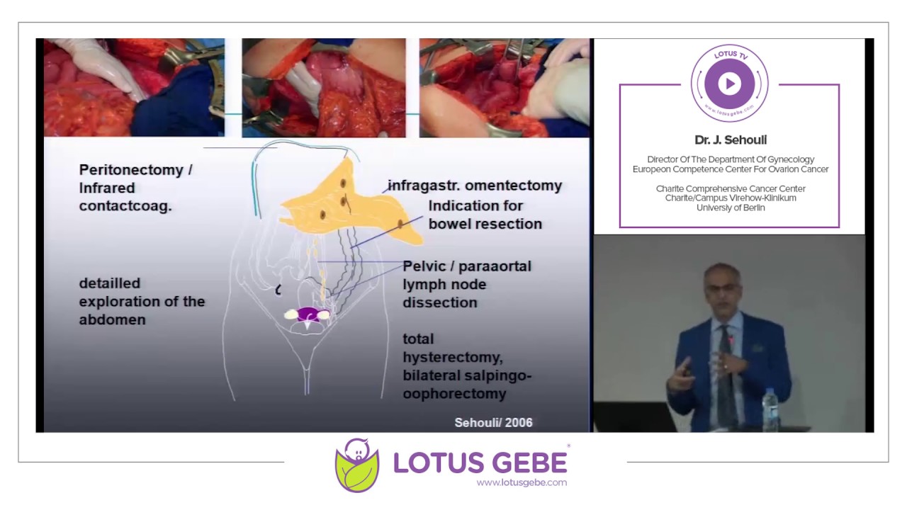 Dr. J Sehouli -Tipps and Tricks in Debulking Surgery - YouTube