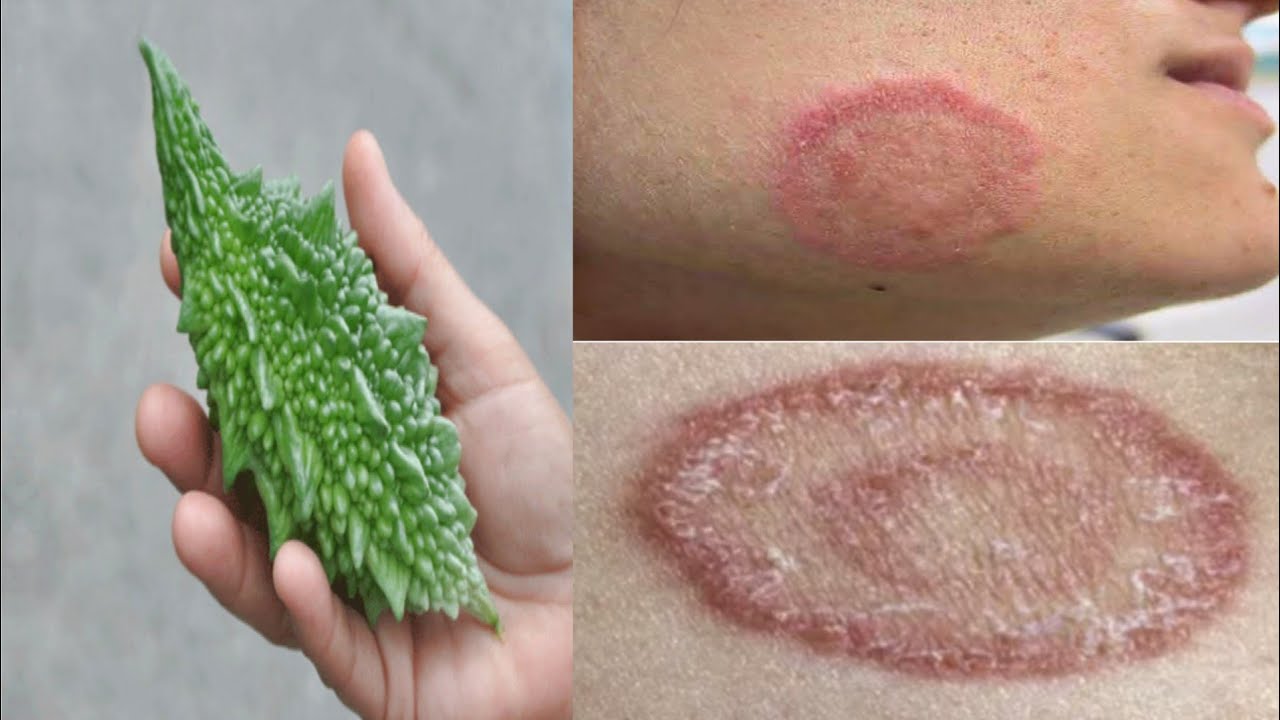 दाद खाज खुजली की 2 दिन में छुट्टी कर देगा | fungal infection treatment ...