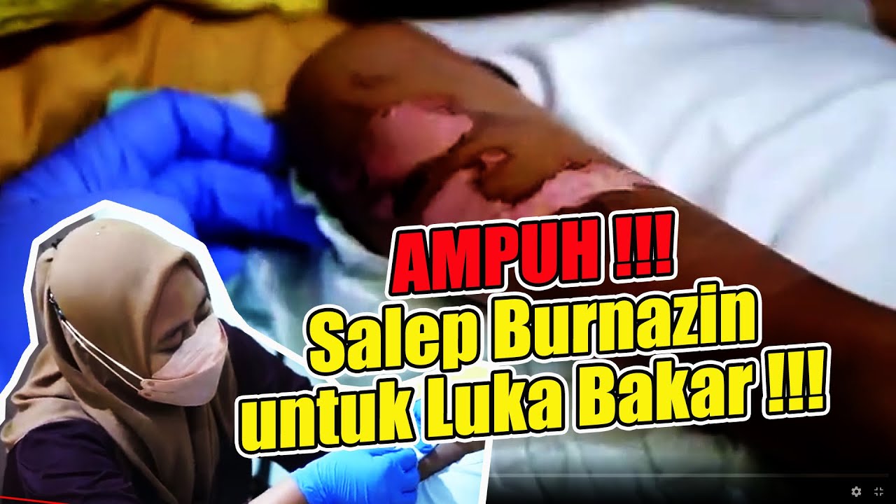 Penggunaan burnazinplus pada luka bakar !! - YouTube