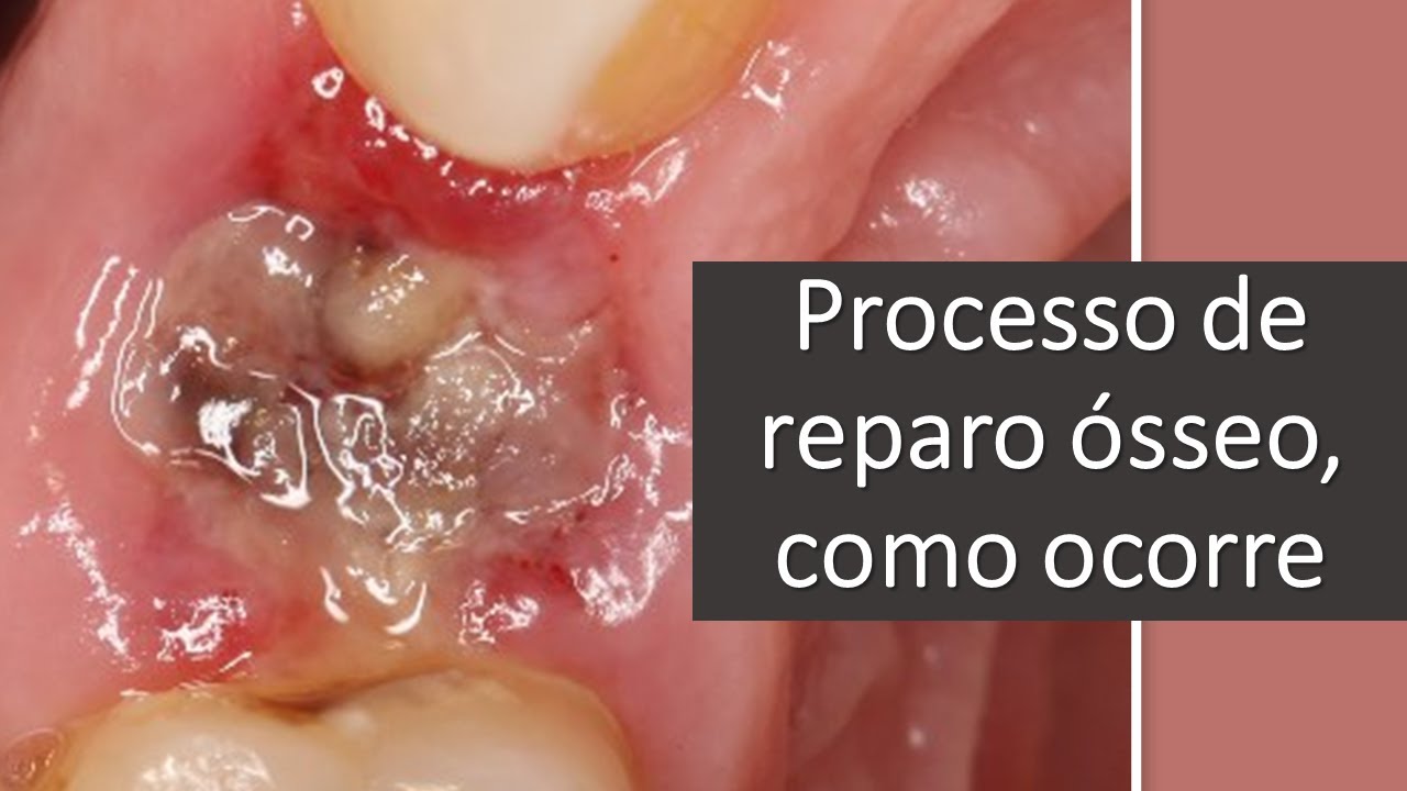 Processo de reparo ósseo como ocorre? | Odontologia | Dra Bianca Rosa ...