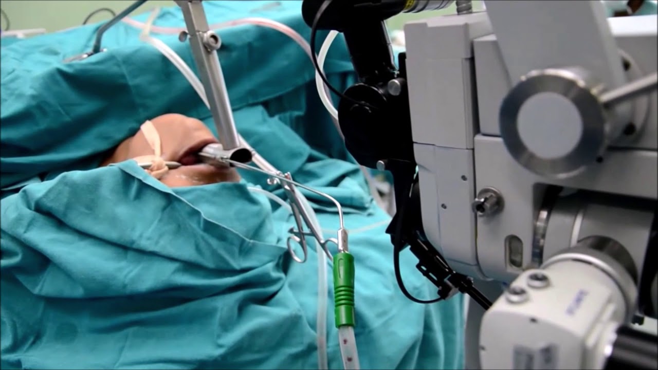 LASER Cordectomy Set up - OM 5.0 (ONCO SURGERY MASTER COURSE) - YouTube