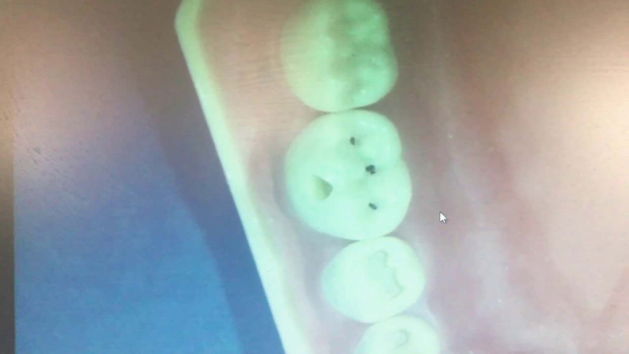 Class one cavity preparation ( Occlusal surface of lower six right side ...