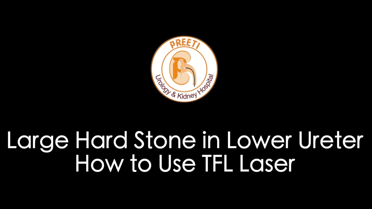 Large Hard Stone in Lower Ureter - How to Use TFL Laser - YouTube