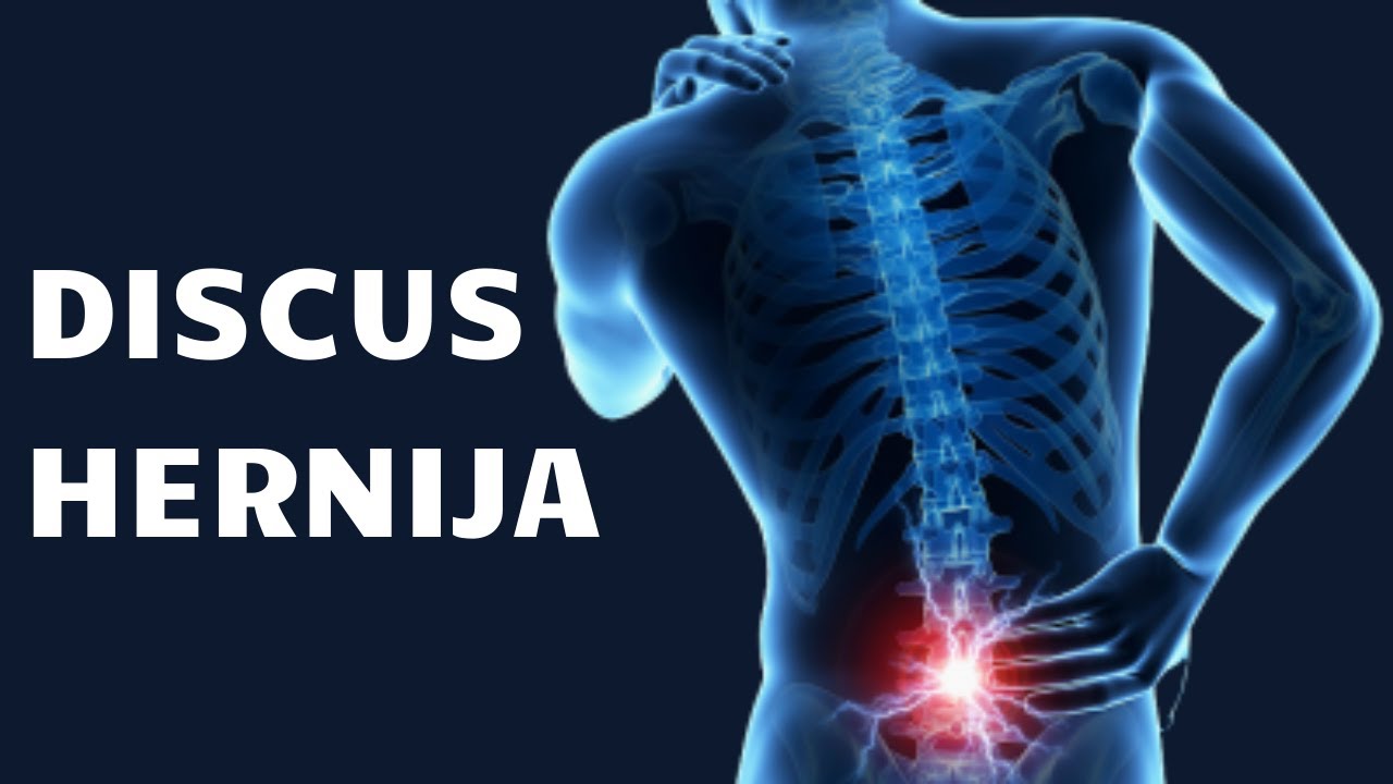 NAJBOLJE VEŽBE ZA DISKUS HERNIJU - YouTube