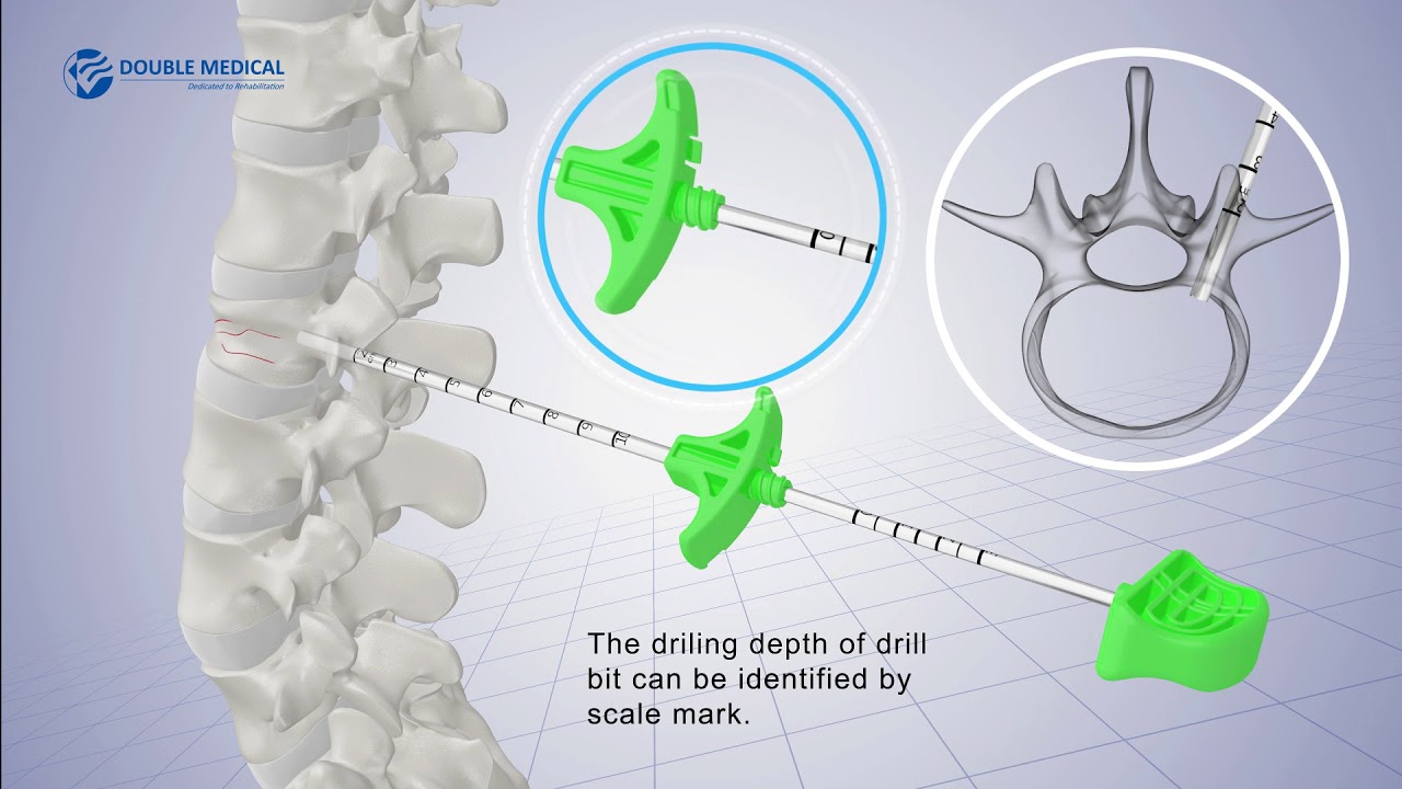 Double Medical Percutaneous Kyphoplasty System - YouTube