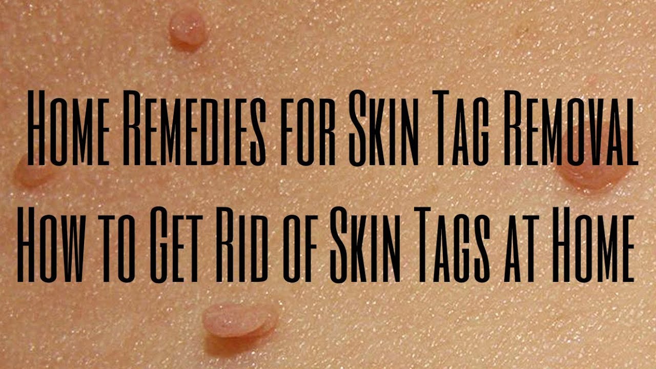 Home Remedies for Skin Tag Removal - How to Get Rid of Skin Tags at ...