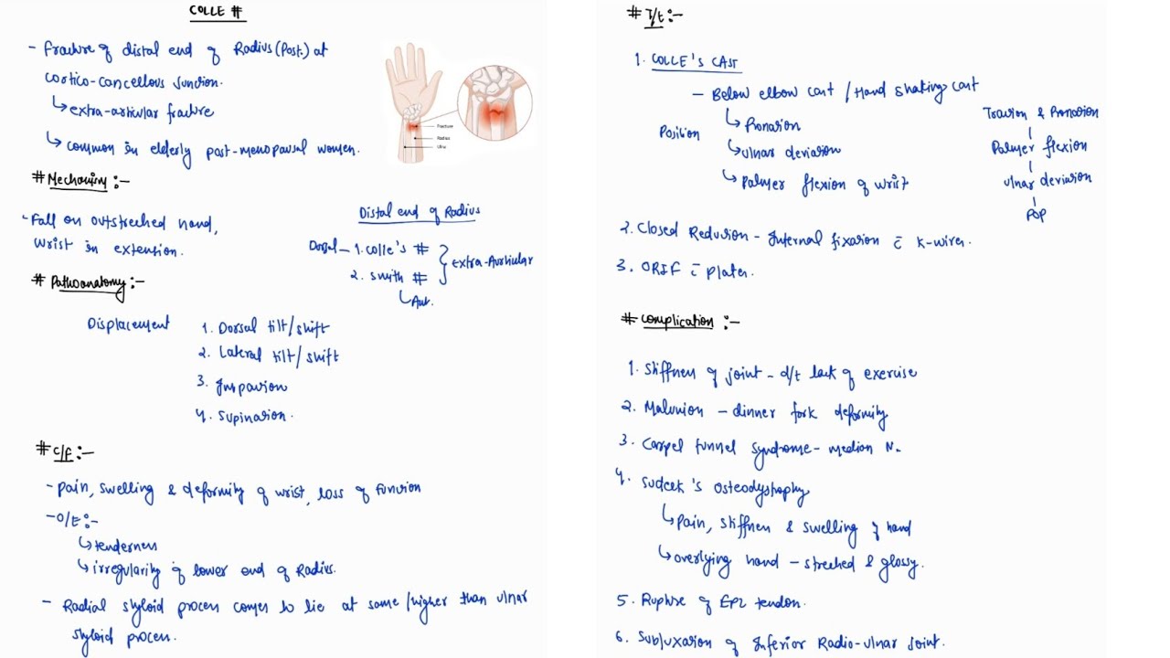 COLLE' FRACTURE NOTES |ONE PAGE NOTES | ORTHOPAEDICS | 4TH PROFF | MBBS ...
