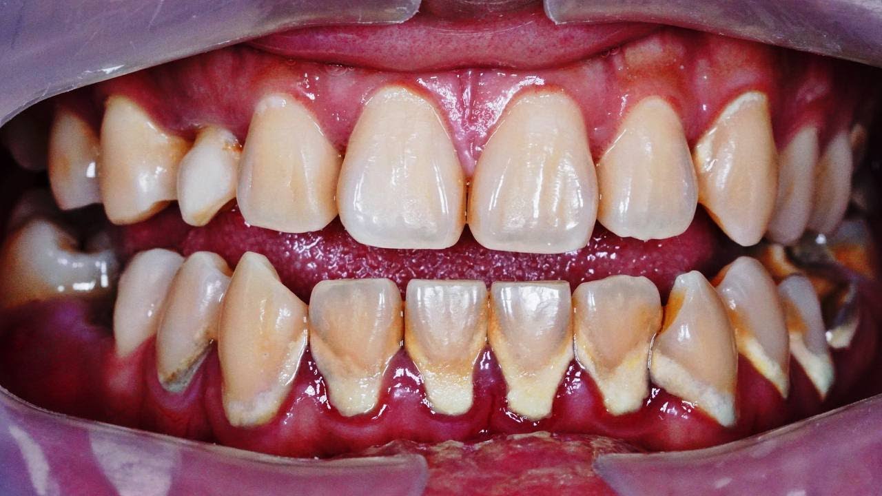 24 yo. Male's Teeth | Scaling | Tartar | Dentist | Dokter Gigi Tri ...