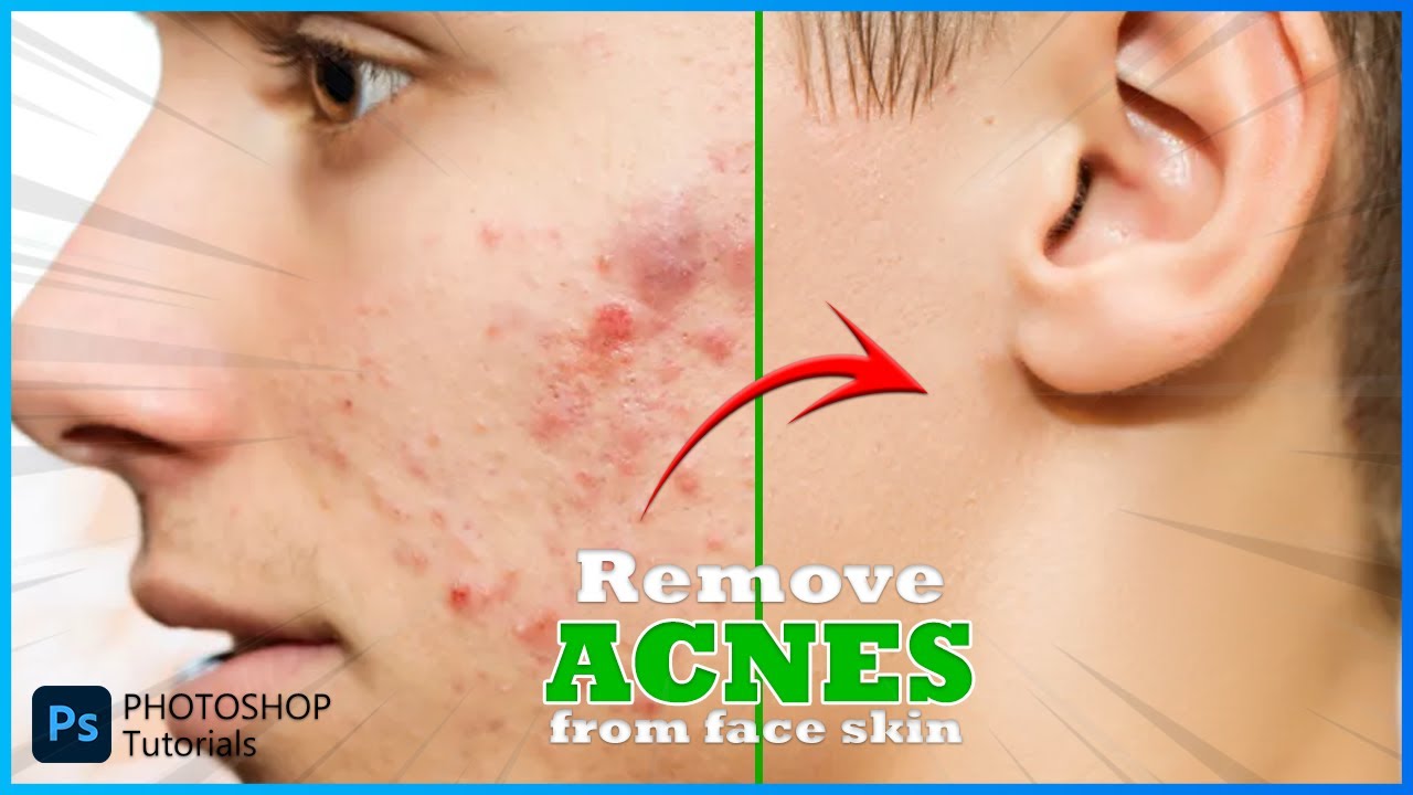 Realistic way to remove Acnes from face skin in Photoshop | Quick ...