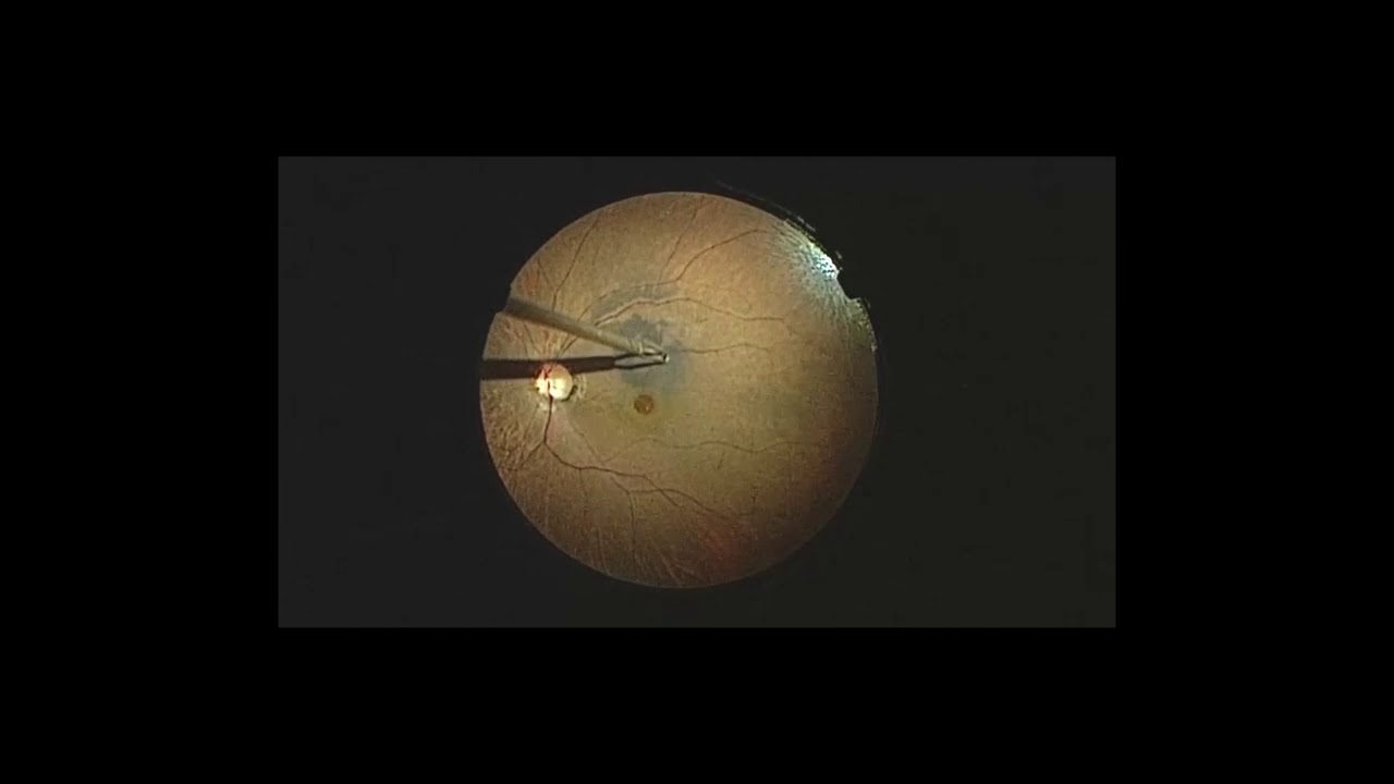 Trasplante autólogo de retina. Autologous retinal transplant - YouTube