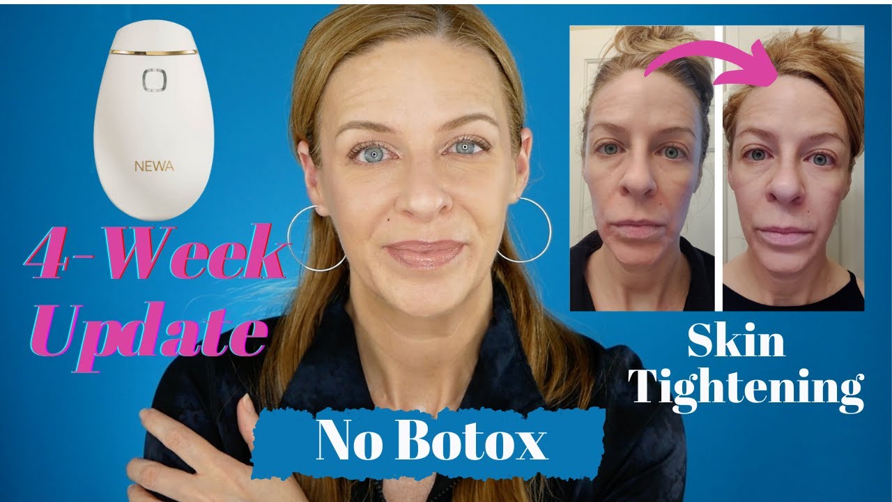 Newa Beauty Radio Frequency Device Before and Afters | No Botox, No ...