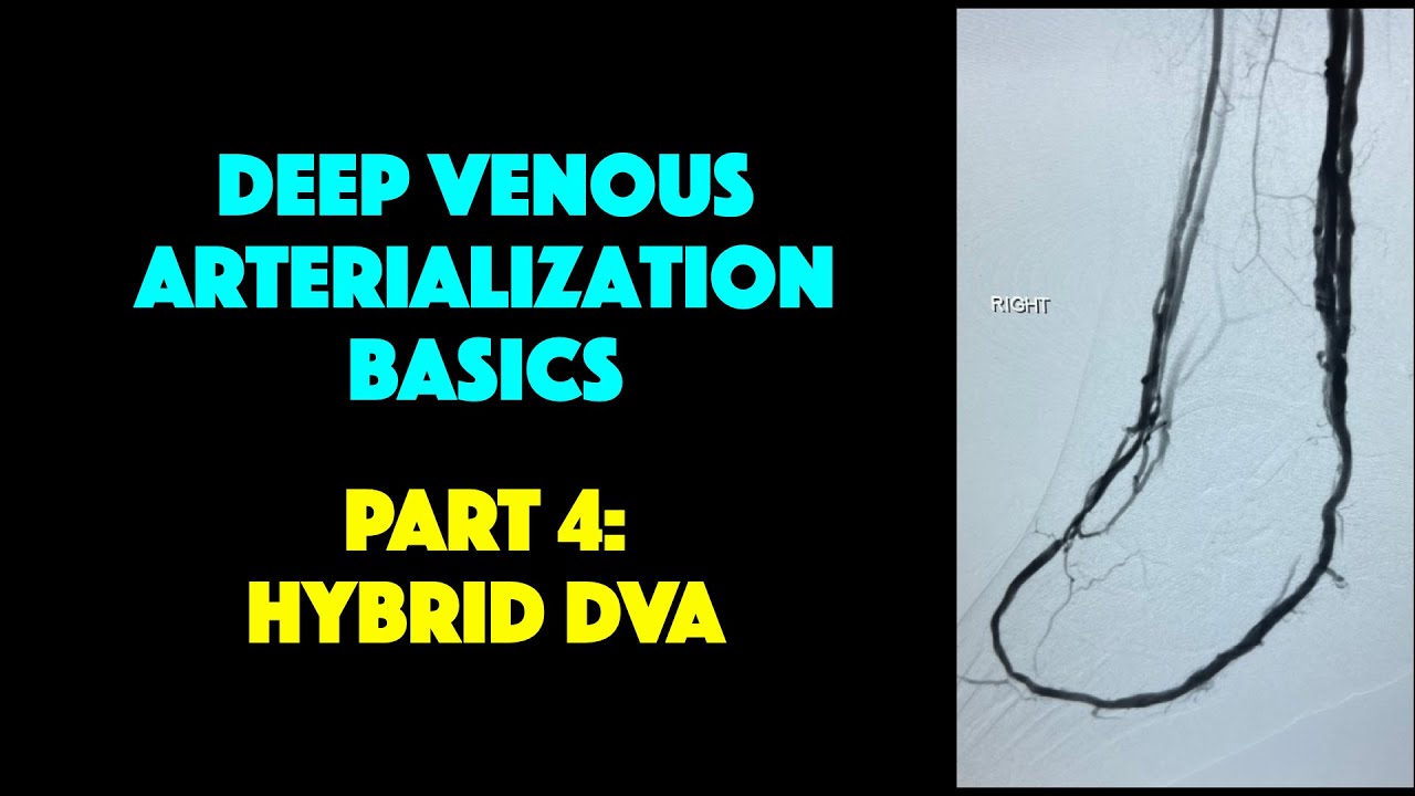 DVA Basics Part 4 of 5: Hybrid DVA (Deep Venous Arterialization) - YouTube