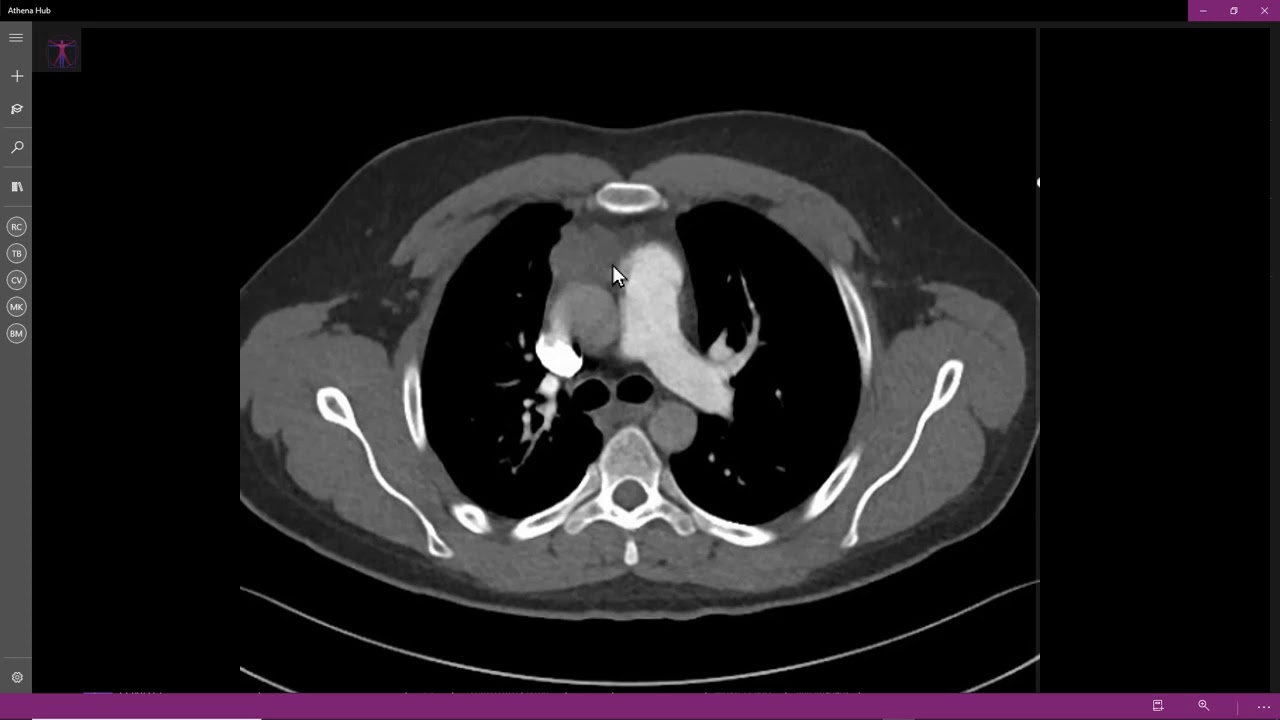 Carcinoma tímico - YouTube