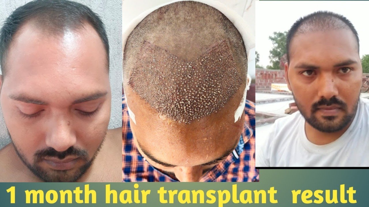 30 days after hair transplant - YouTube