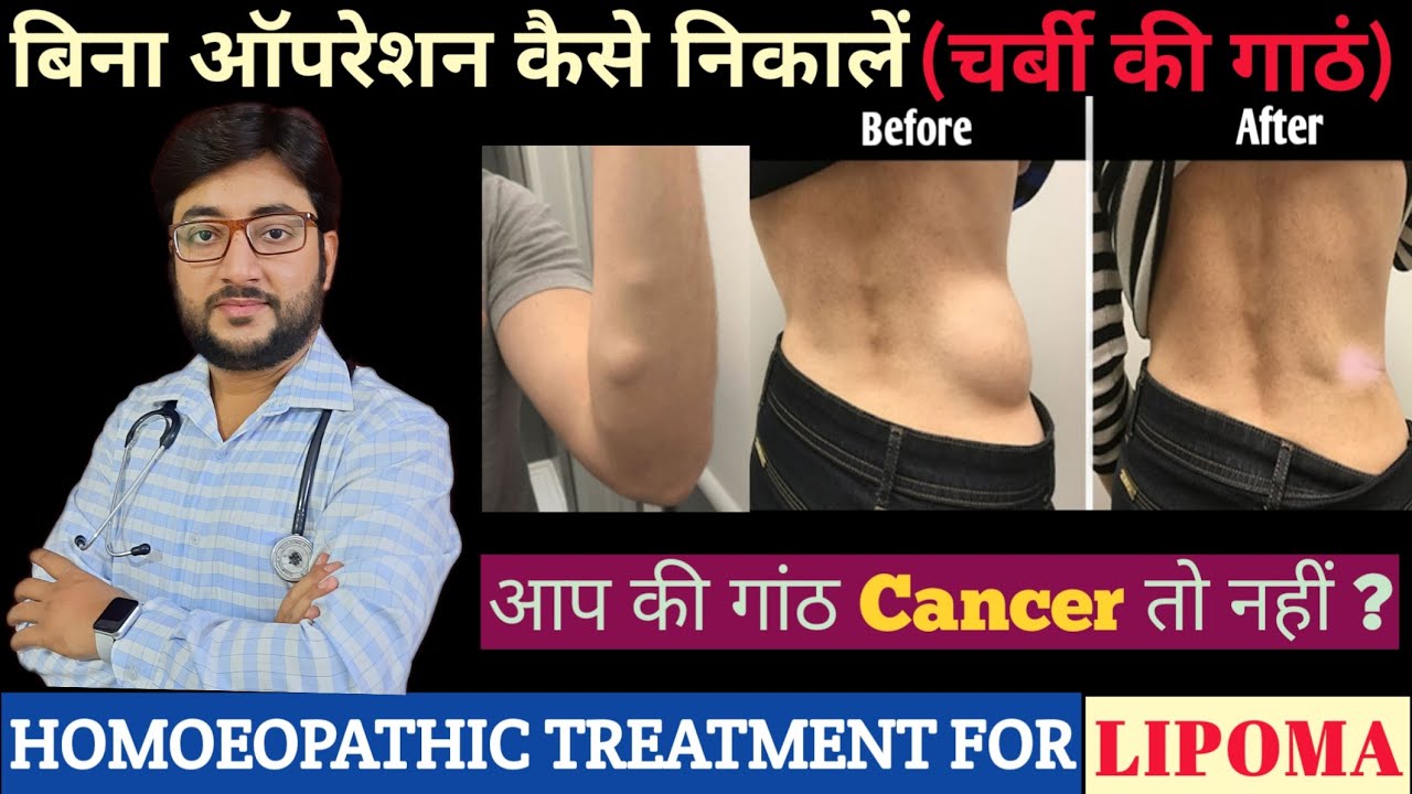 बिना ऑपरेशन के LIPOMA ( चर्बी की गाठं) का इलाज | charbi ki ganth ka ...