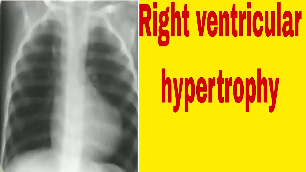 Right Ventricular Hypertrophy complication in chest X-ray and CT scan ...