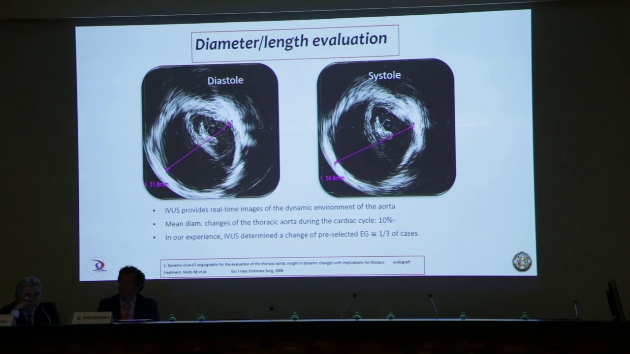 33. The use of IVUS in Type B Dissection by Dr Roberto Silingardi - YouTube