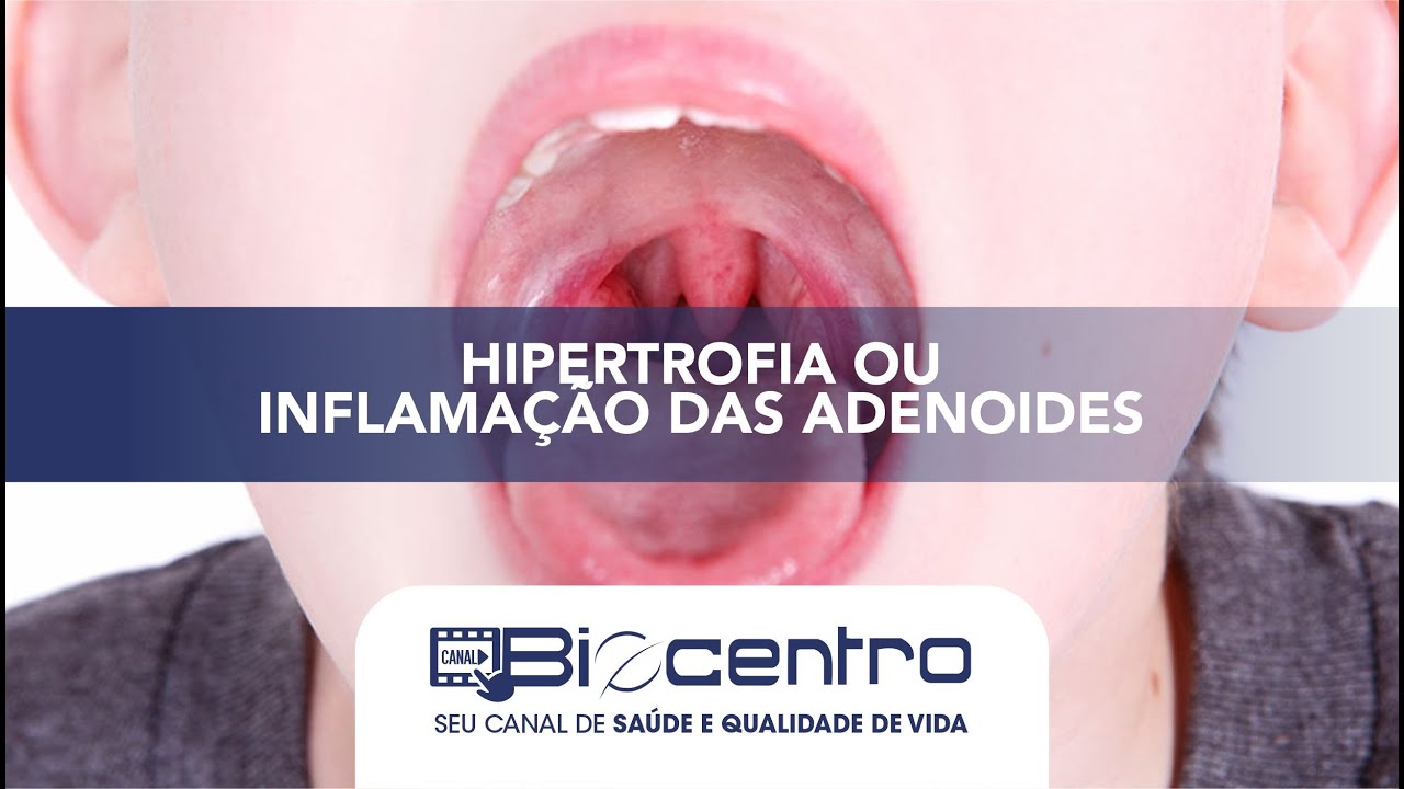 Hipertrofia Ou Inflamação Das Adenoides - YouTube