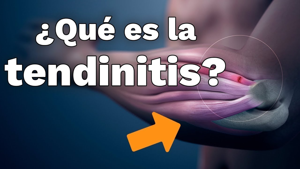 QUÉ ES LA TENDINITIS y qué hacer para curarla rápido - YouTube